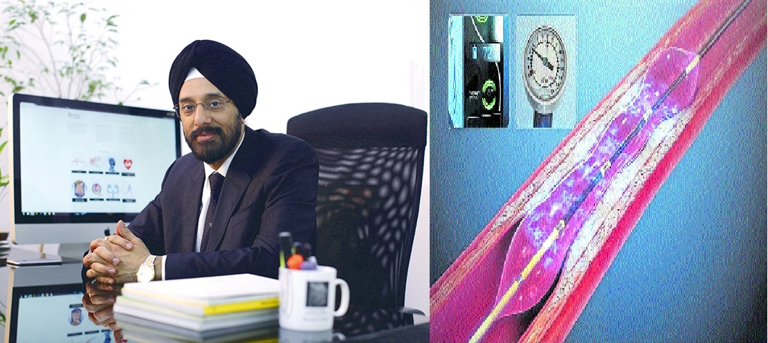 Cardiologist uses Shock Wave technology to open blocked arteries - The ...