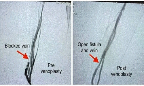 Hemodialysis Fistula Venoplasty facility now available at Super ...